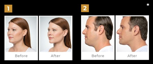 Fat Dissolving Injection - Instant Laser Clinic